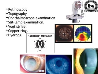 Keratoconus... | PPT