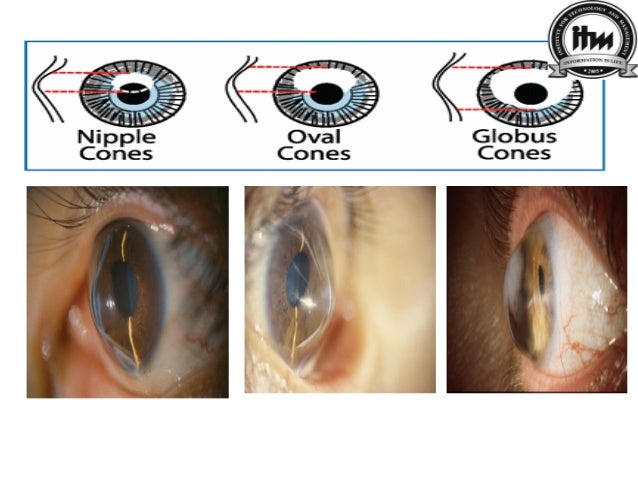 Keratoconus...