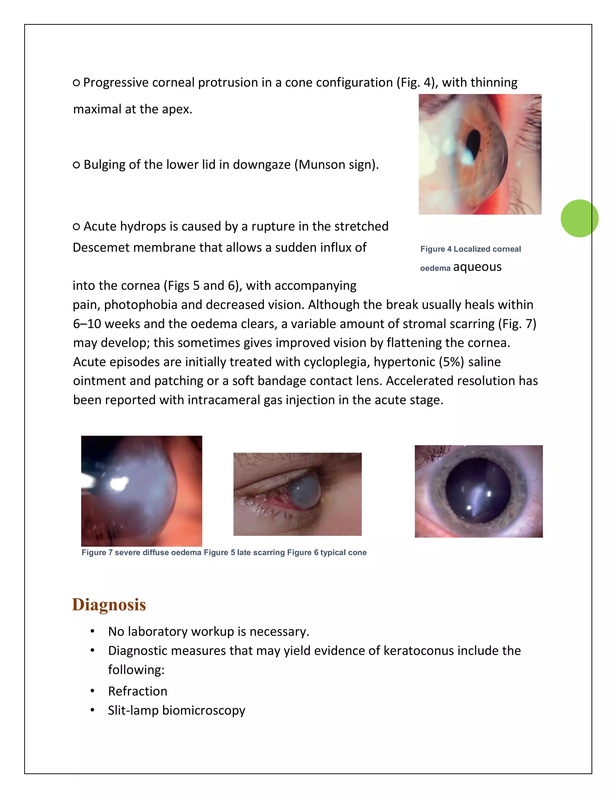 Keratoconus | PDF