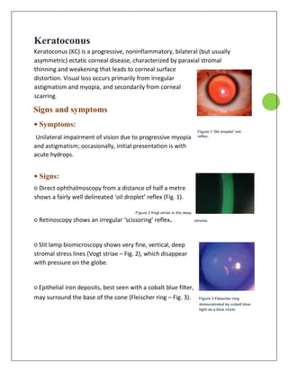 Keratoconus | PDF