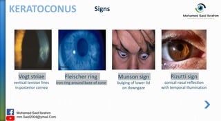 Keratoconus القرنية المخروطية | PPTX