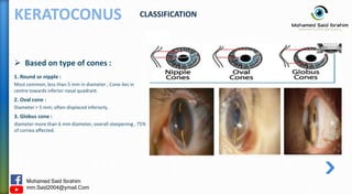 Keratoconus القرنية المخروطية | PPTX