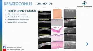 Keratoconus القرنية المخروطية | PPTX