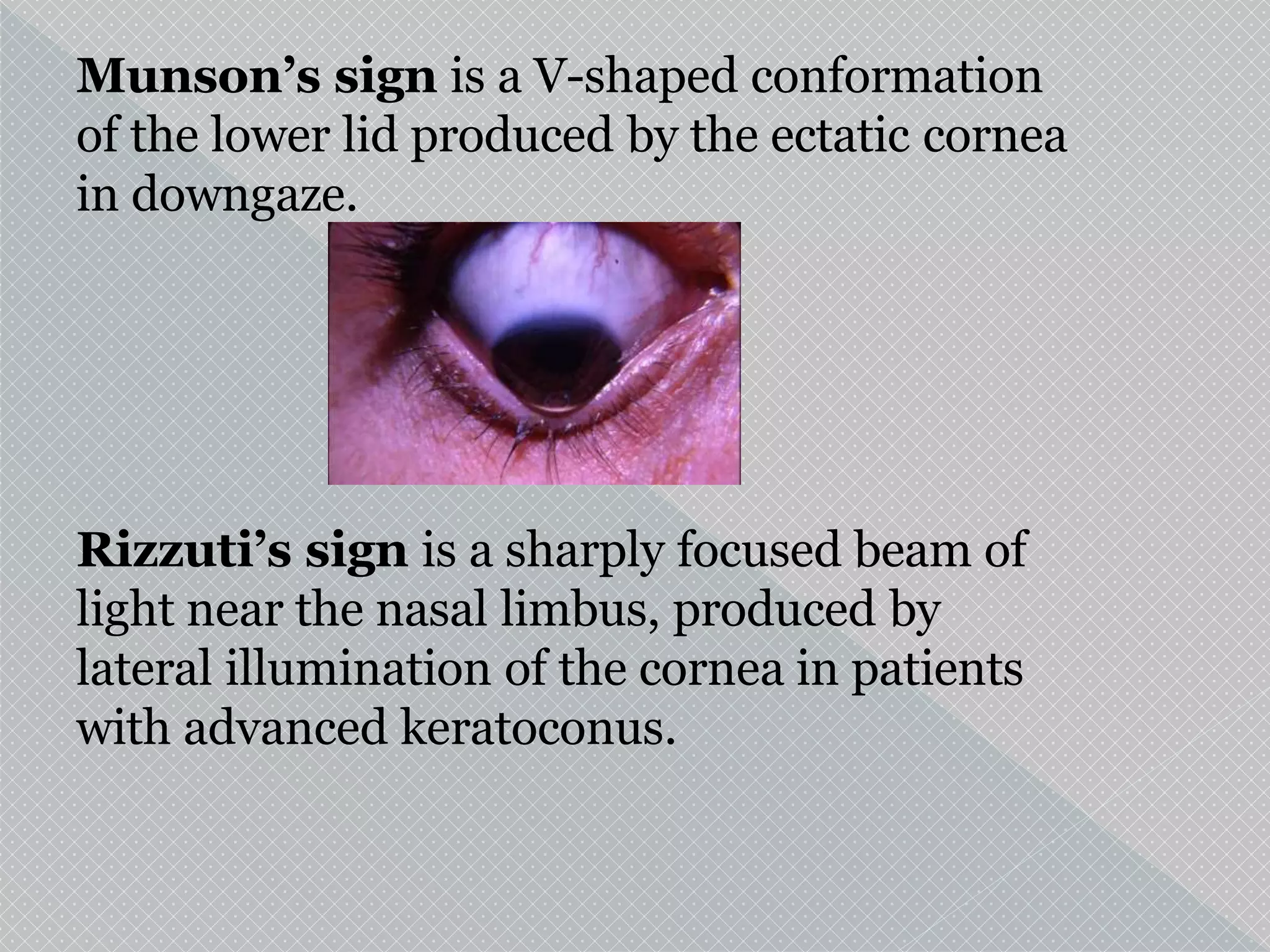 Keratoconus | PPTX