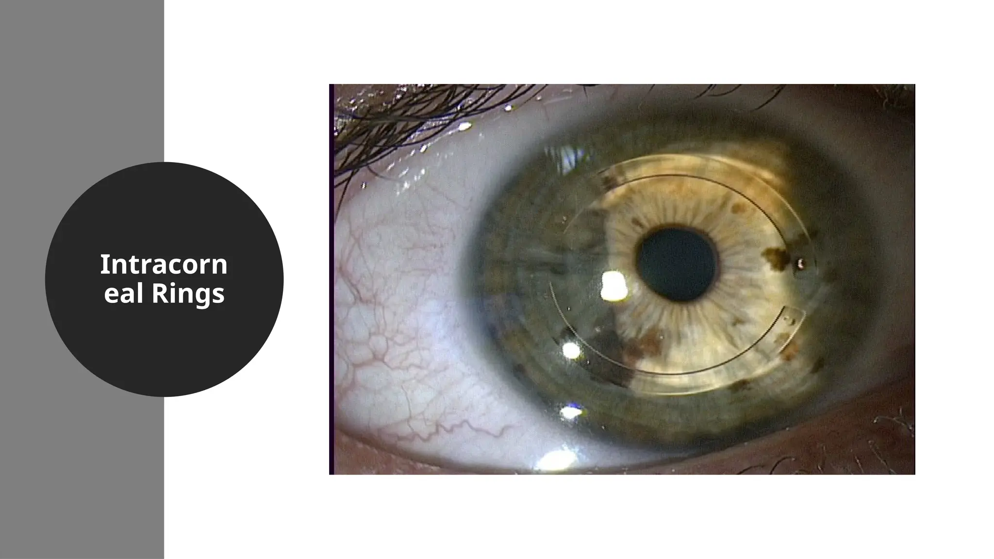 Diagnosis and management of Keratoconus cases | PPTX
