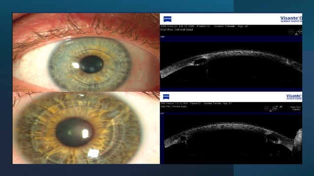 Diagnosis and management of Keratoconus cases | PPTX | Eye and Vision ...