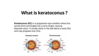 Keratoconus clinical case discussion .. Keratoconus (KC) is a ...