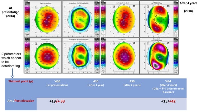 Keratoconus a case of asymmetric keratoconus and management protocol | PPT
