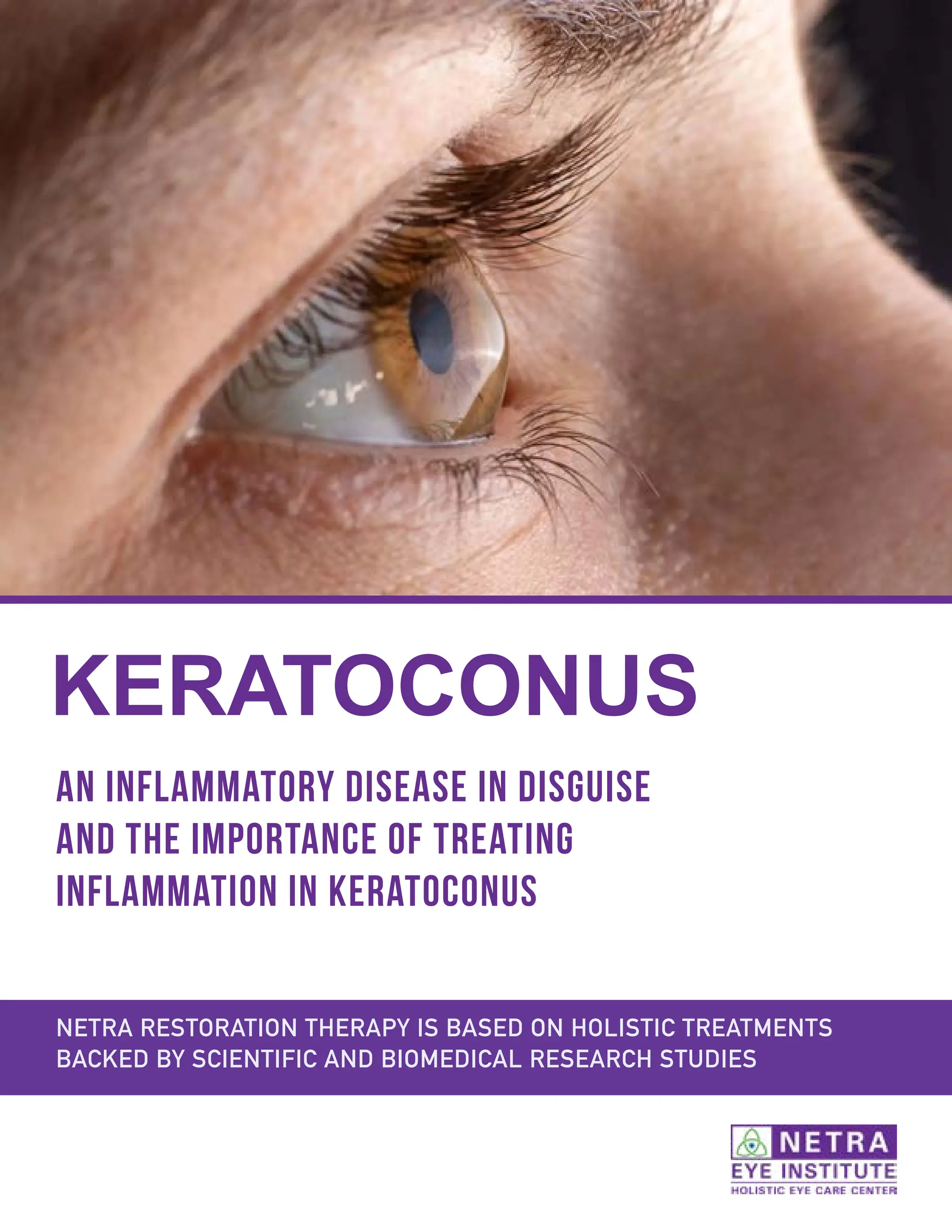 Keratoconus-An Inflammatory Disease in Disguise-Paper.pdf