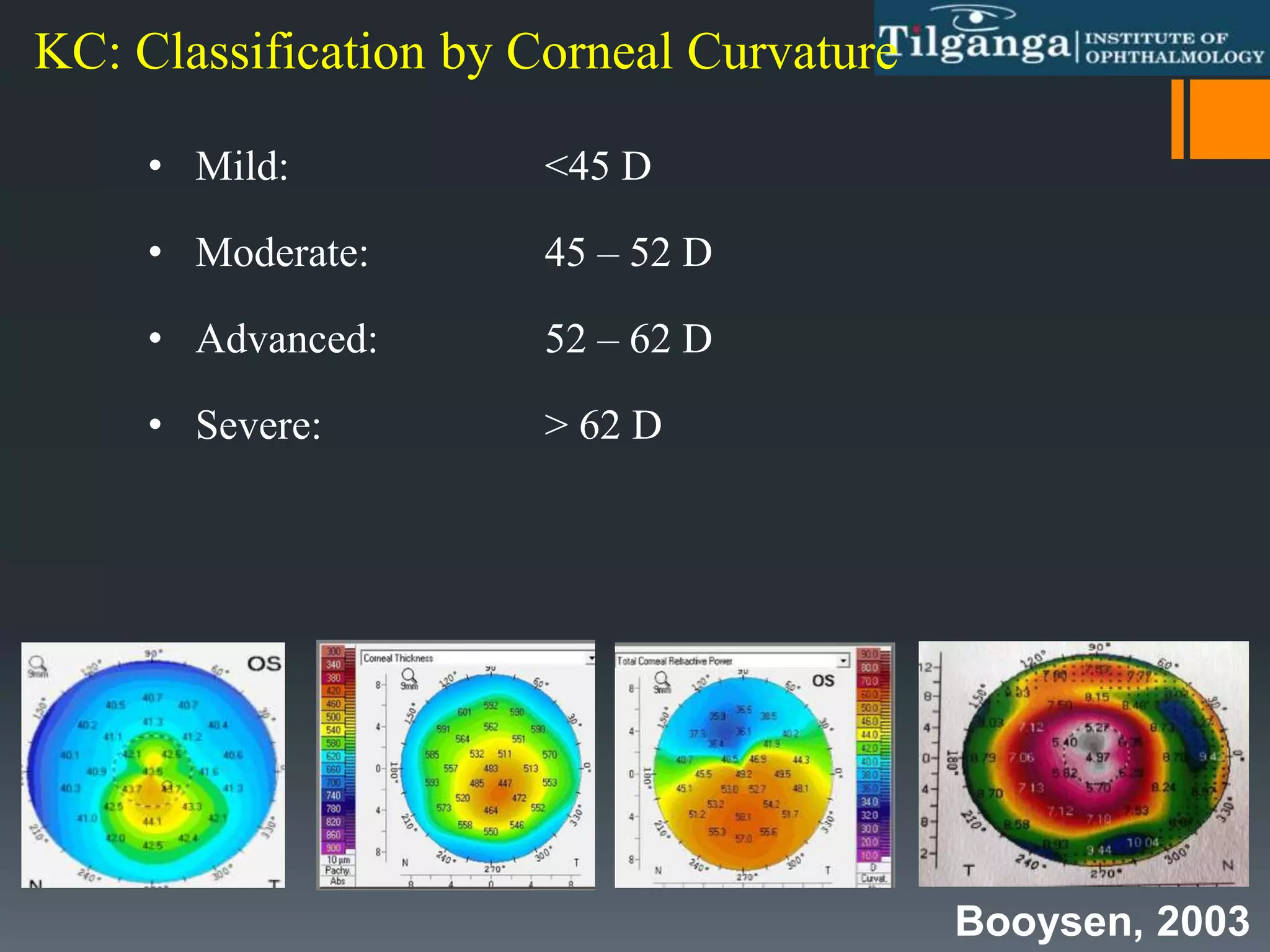 Keratoconus and Its management | PPTX