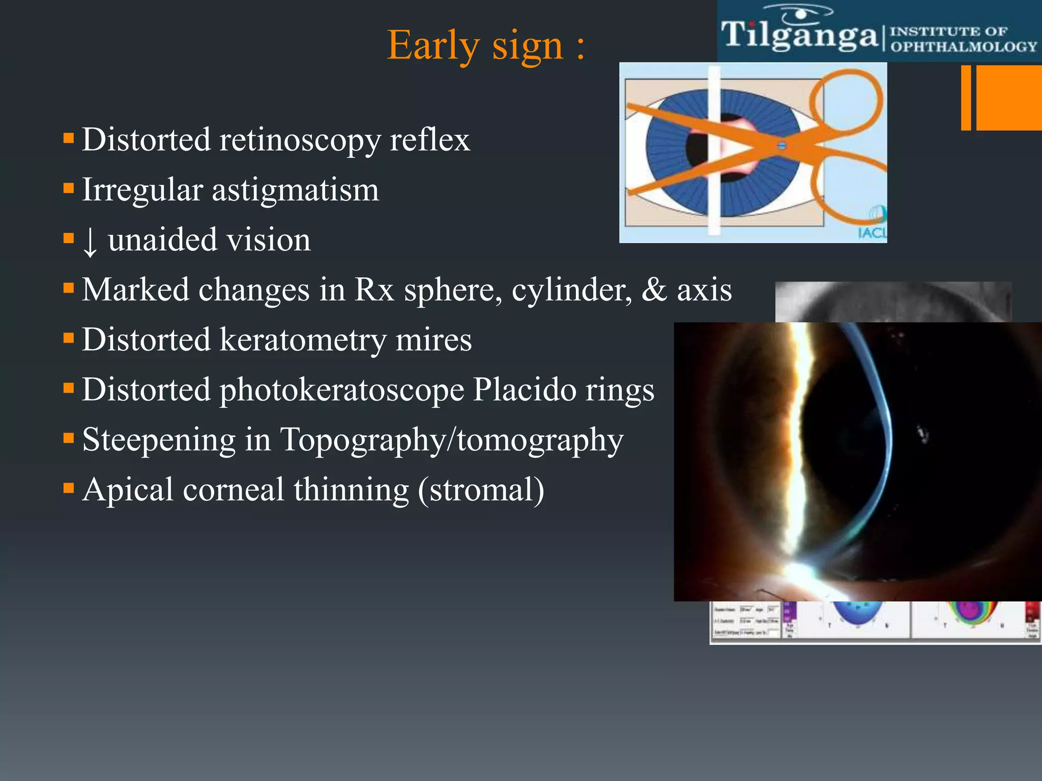 Keratoconus and Its management | PPTX