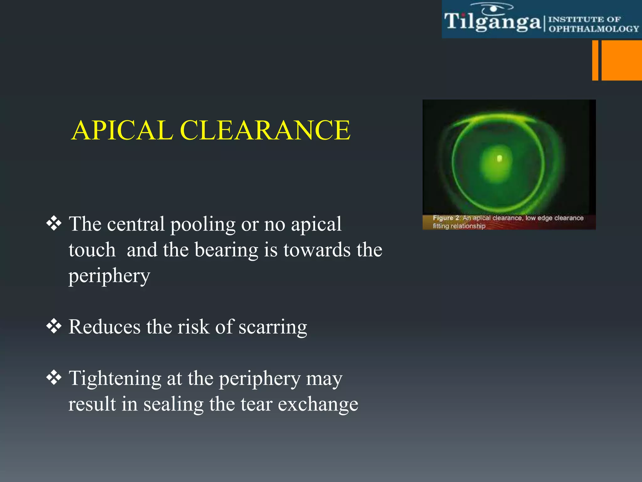 Keratoconus and Its management | PPTX