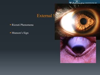 Rizzuti Sign Keratoconus