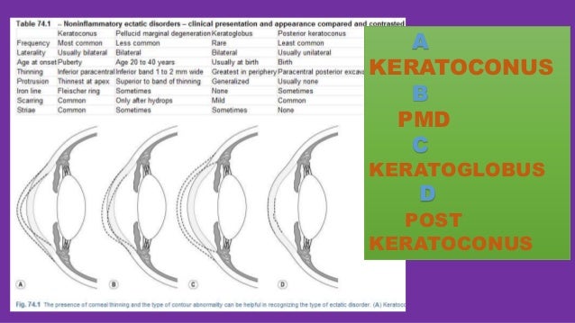 Keratoconus 2016