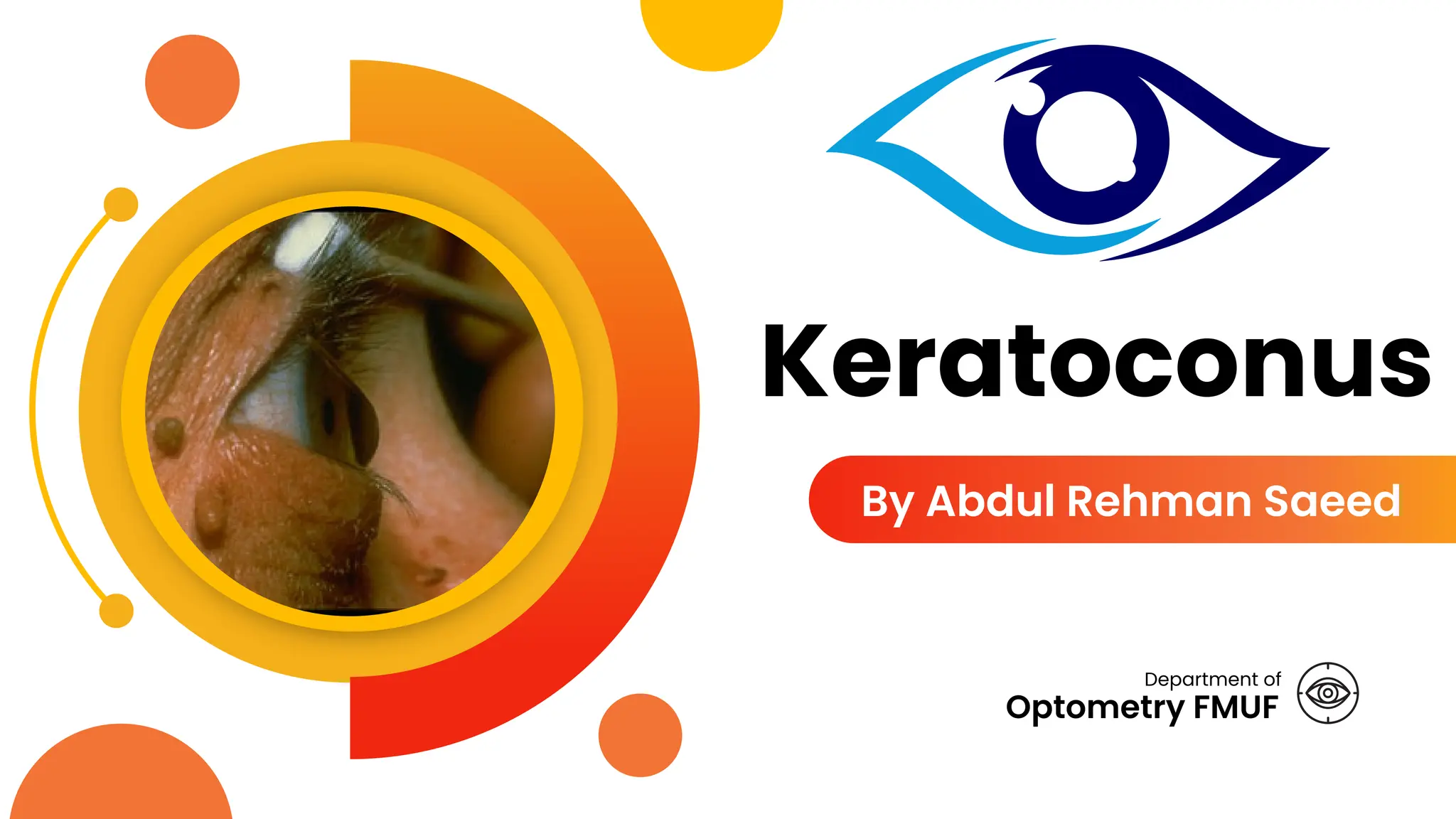 Keratoconus , symptoms , types & treatment | PPT