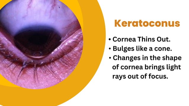 Keratoconus , symptoms , types & treatment | PPT