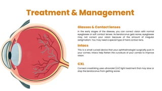 Keratoconus , symptoms , types & treatment | PDF