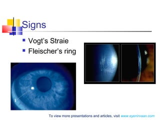 Keratoconus and collagen cross linking- Basic opthalmoscopy findings ...