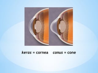 Keratoconus Basics.pptx ophthalmology presentataion | PPT