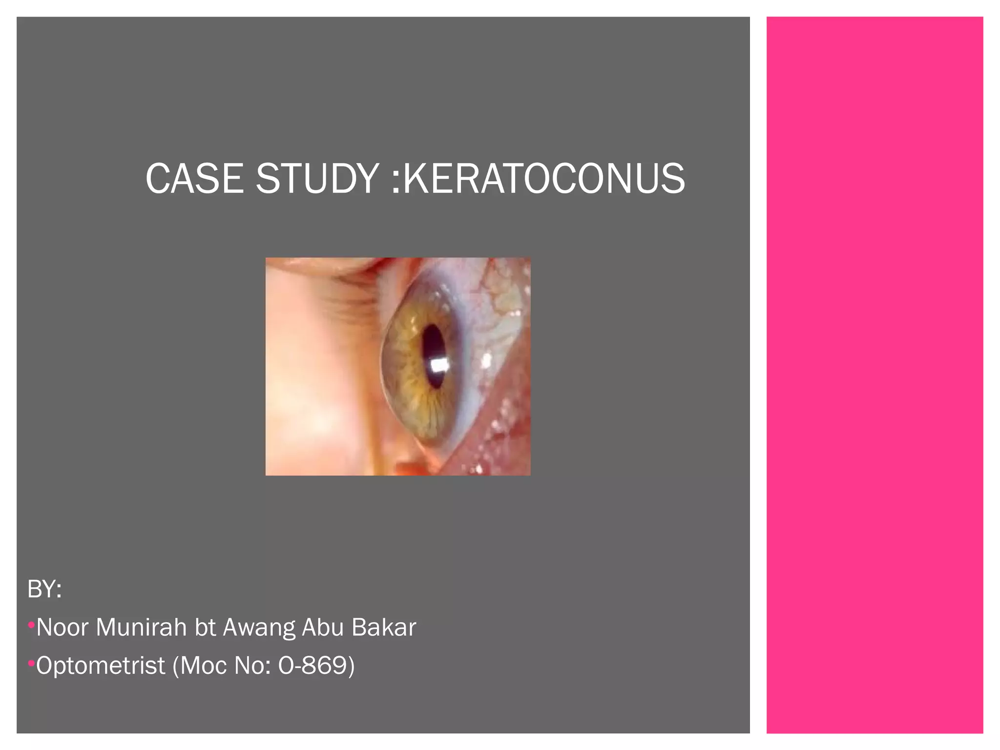Contact lens for Keratoconus case study | PPT