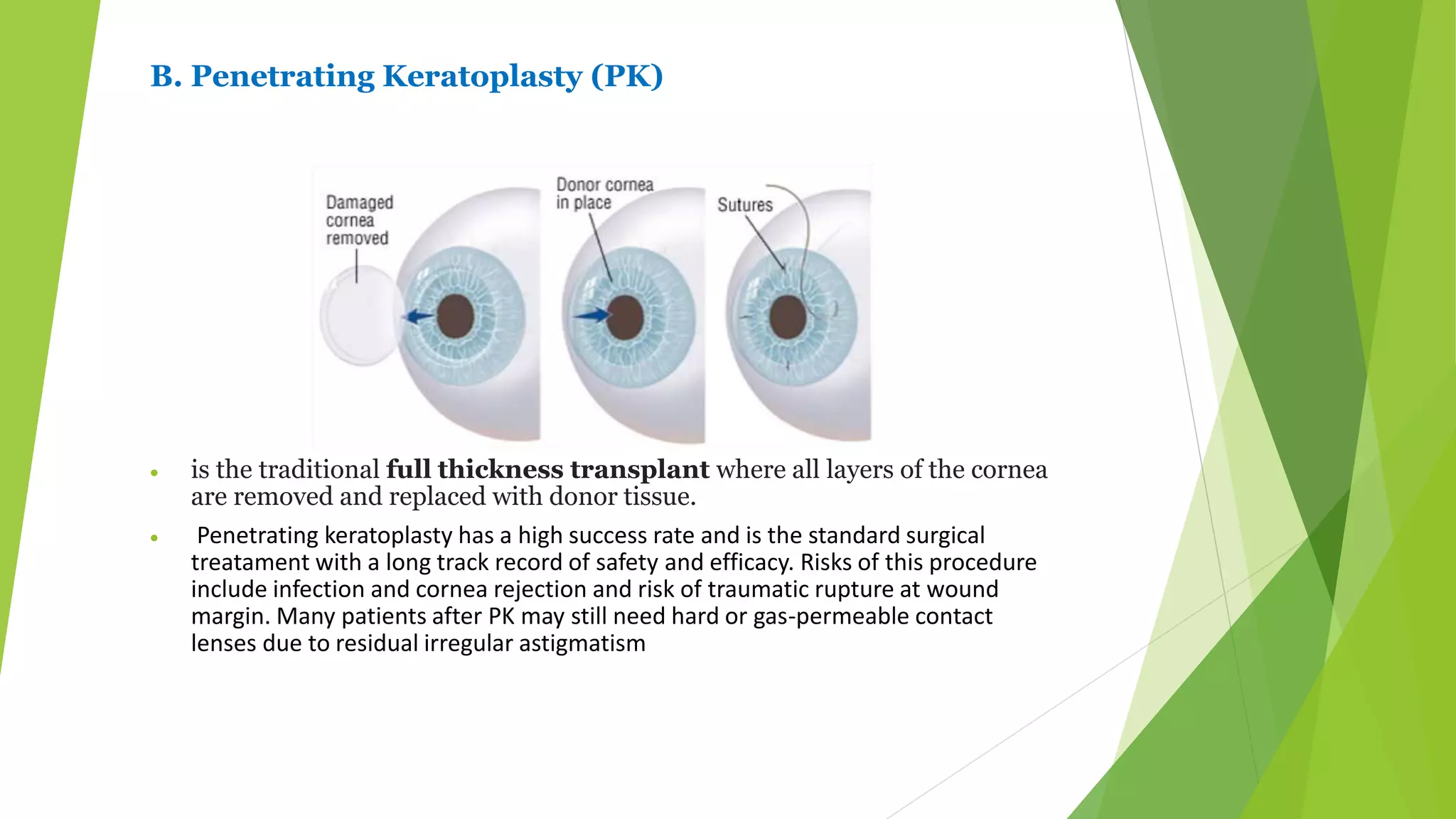 Keratoconus ,diagnosis and treatment | PPTX
