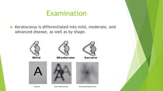 Keratoconus ,diagnosis and treatment | PPTX