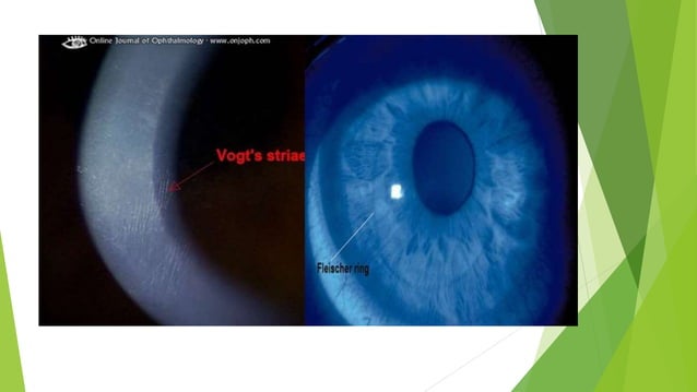 Keratoconus Diagnosis And Treatment Ppt