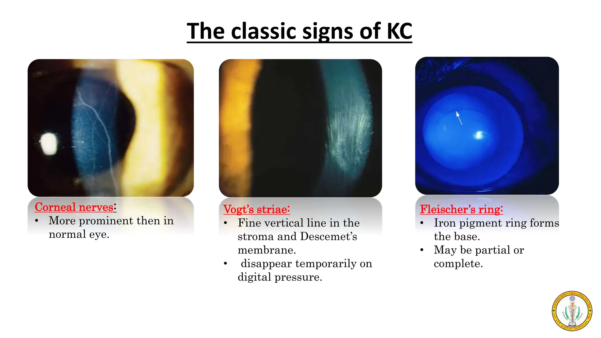 Keratoconus & it’s management (kunj).pptx