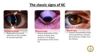 Keratoconus & it’s management (kunj).pptx