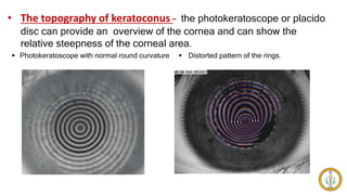Keratoconus & it’s management (kunj).pptx