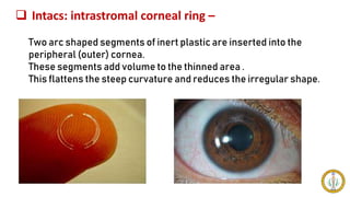 Keratoconus & it’s management (kunj).pptx