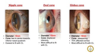 Keratoconus & it’s management (kunj).pptx