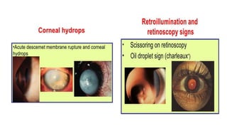 Keratoconus, lenticonus, lentiglobus , microspherophakia & | PPTX