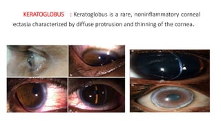 Keratoconus, lenticonus, lentiglobus , microspherophakia & | PPTX