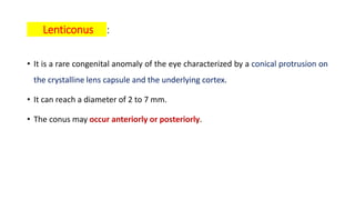 Keratoconus, lenticonus, lentiglobus , microspherophakia & | PPTX