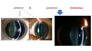 Keratoconus, lenticonus, lentiglobus , microspherophakia & | PPTX