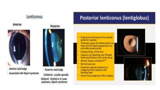 Keratoconus, lenticonus, lentiglobus , microspherophakia & | PPTX