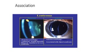 Keratoconus, lenticonus, lentiglobus , microspherophakia & | PPTX