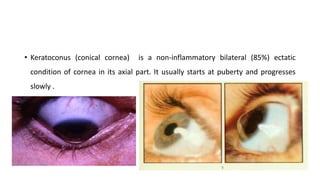 Keratoconus, lenticonus, lentiglobus , microspherophakia & | PPTX