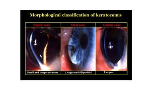 Keratoconus, lenticonus, lentiglobus , microspherophakia & | PPTX