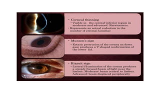 Keratoconus, lenticonus, lentiglobus , microspherophakia & | PPTX