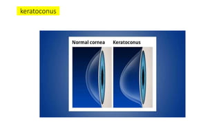 Lenticonus