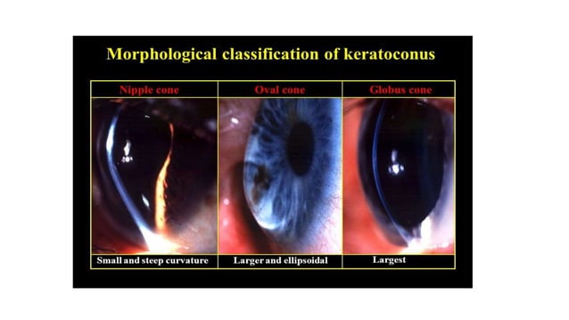 Keratoconus, lenticonus, lentiglobus , microspherophakia
