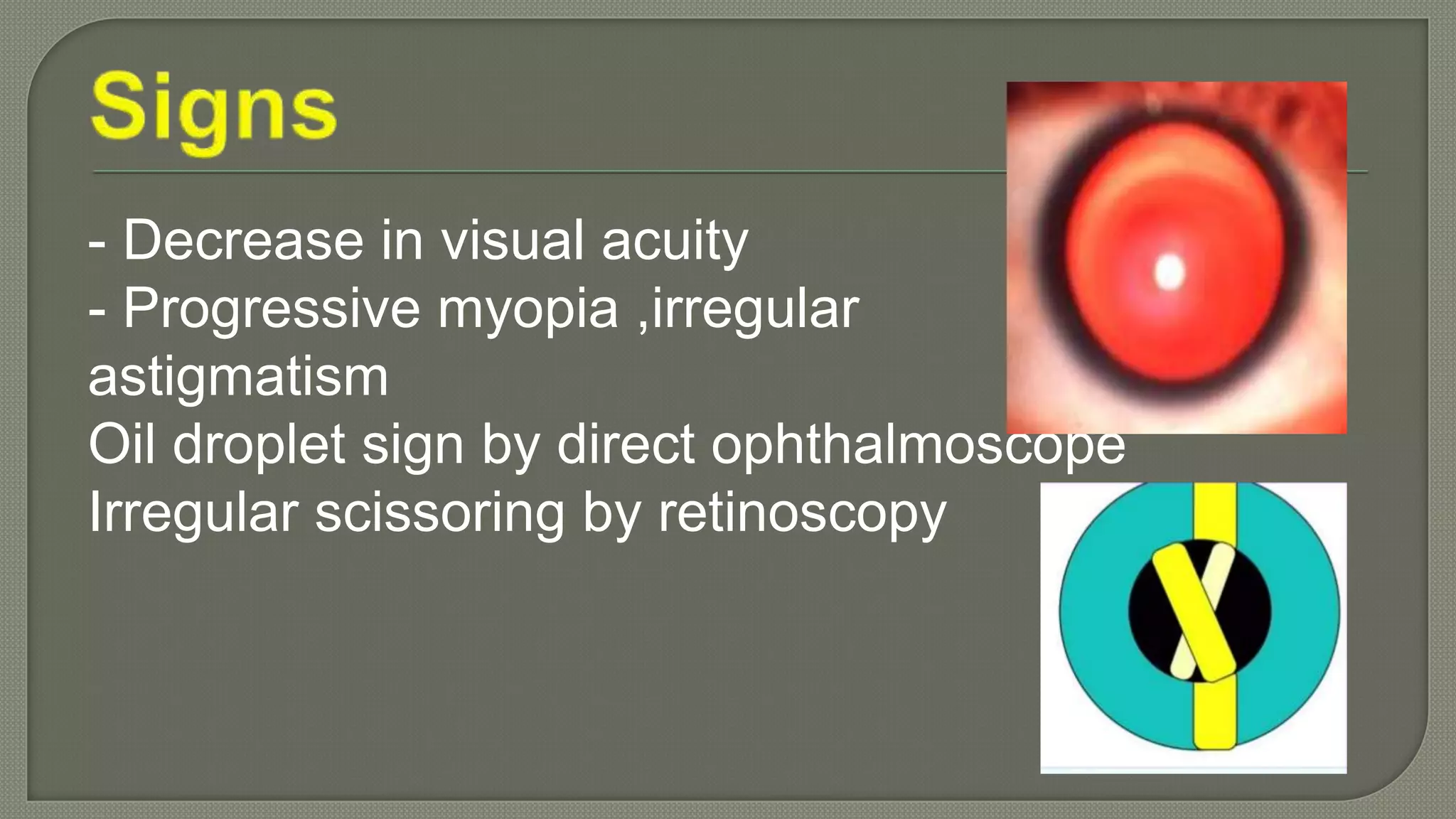 Keratoconus mangment | PPTX