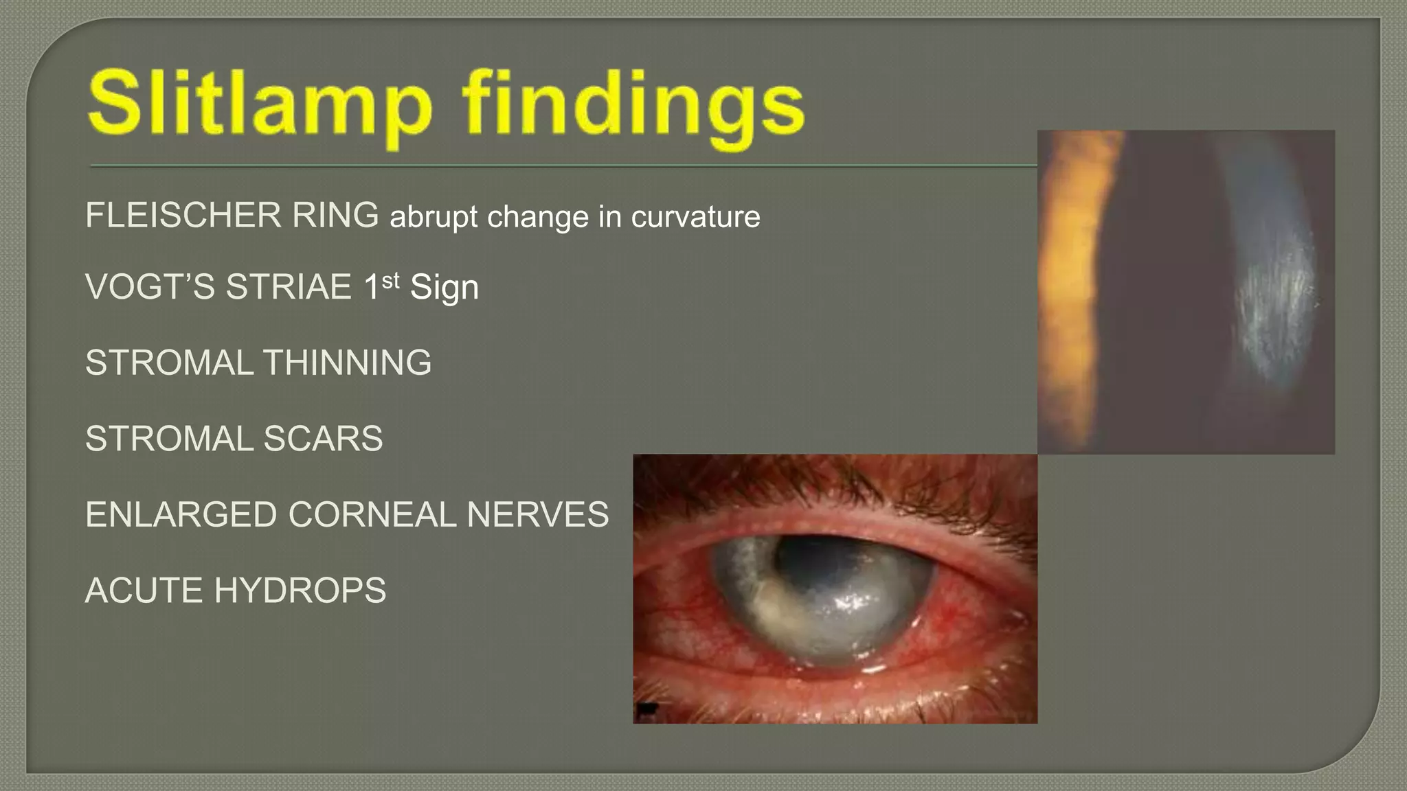 Keratoconus mangment | PPTX