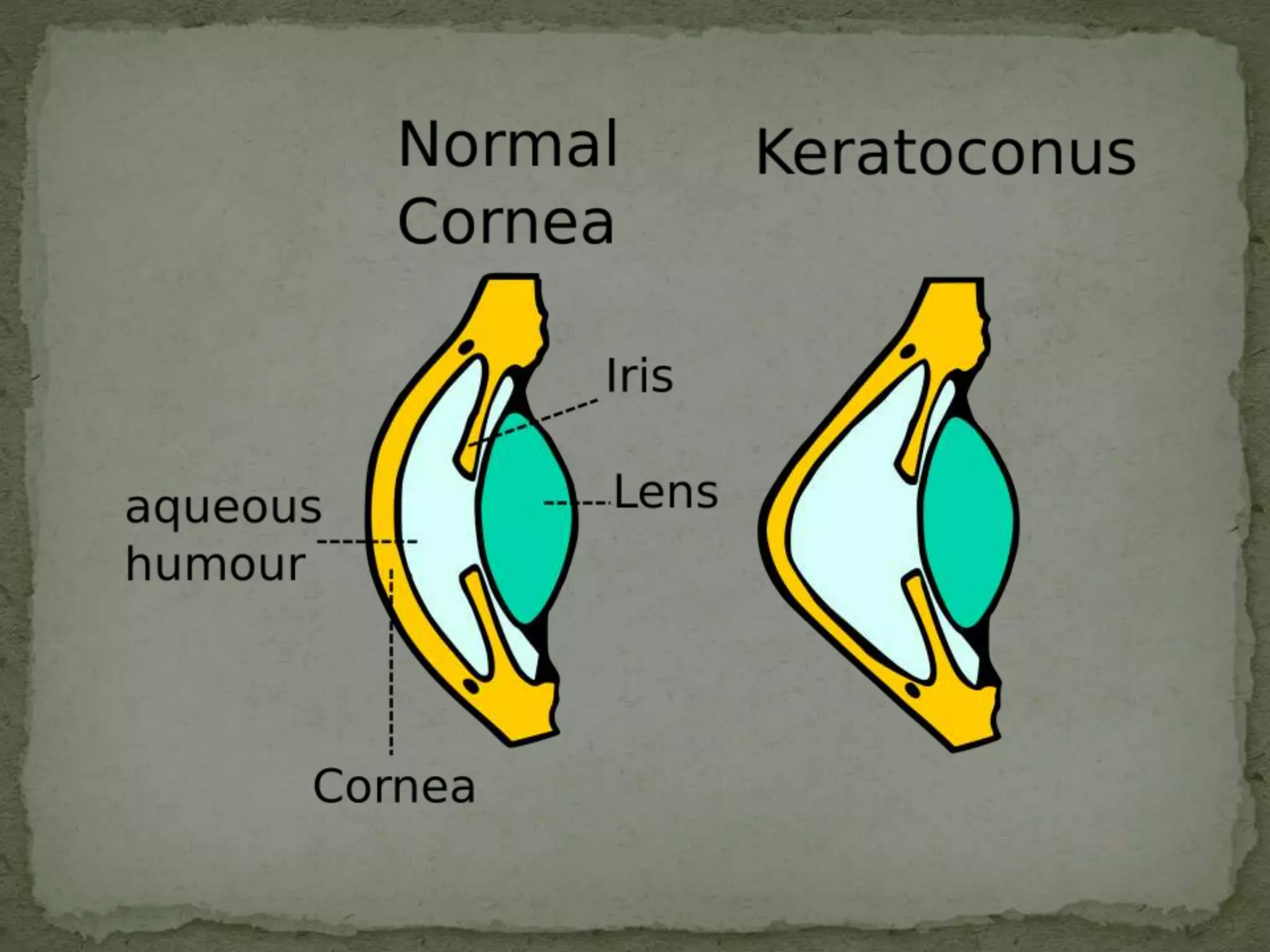 Keratoconus | PPTX
