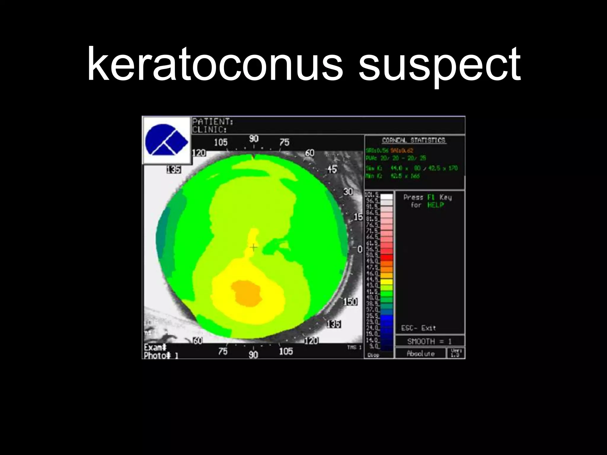 Keratoconus | PPTX
