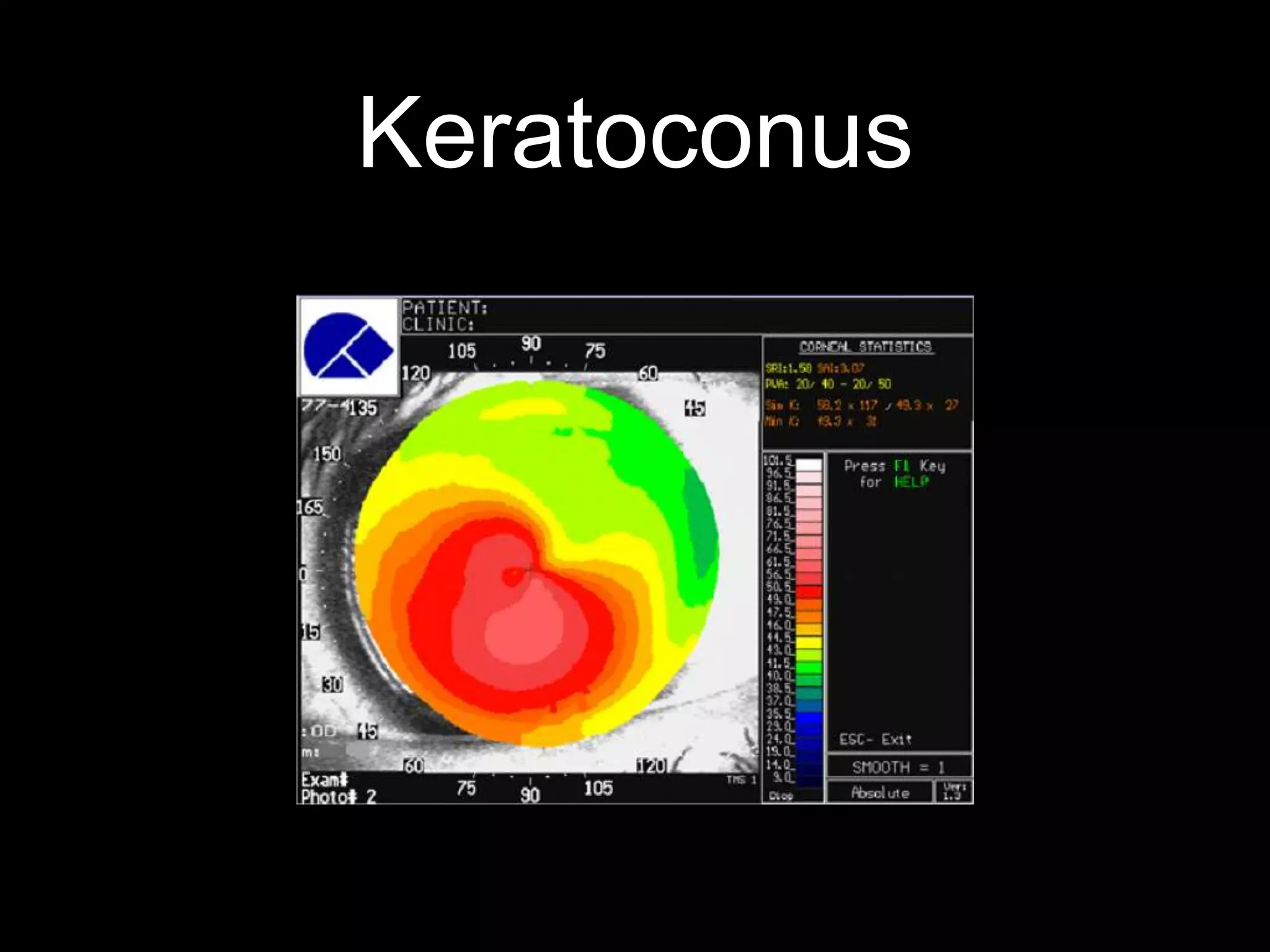 Keratoconus | PPTX