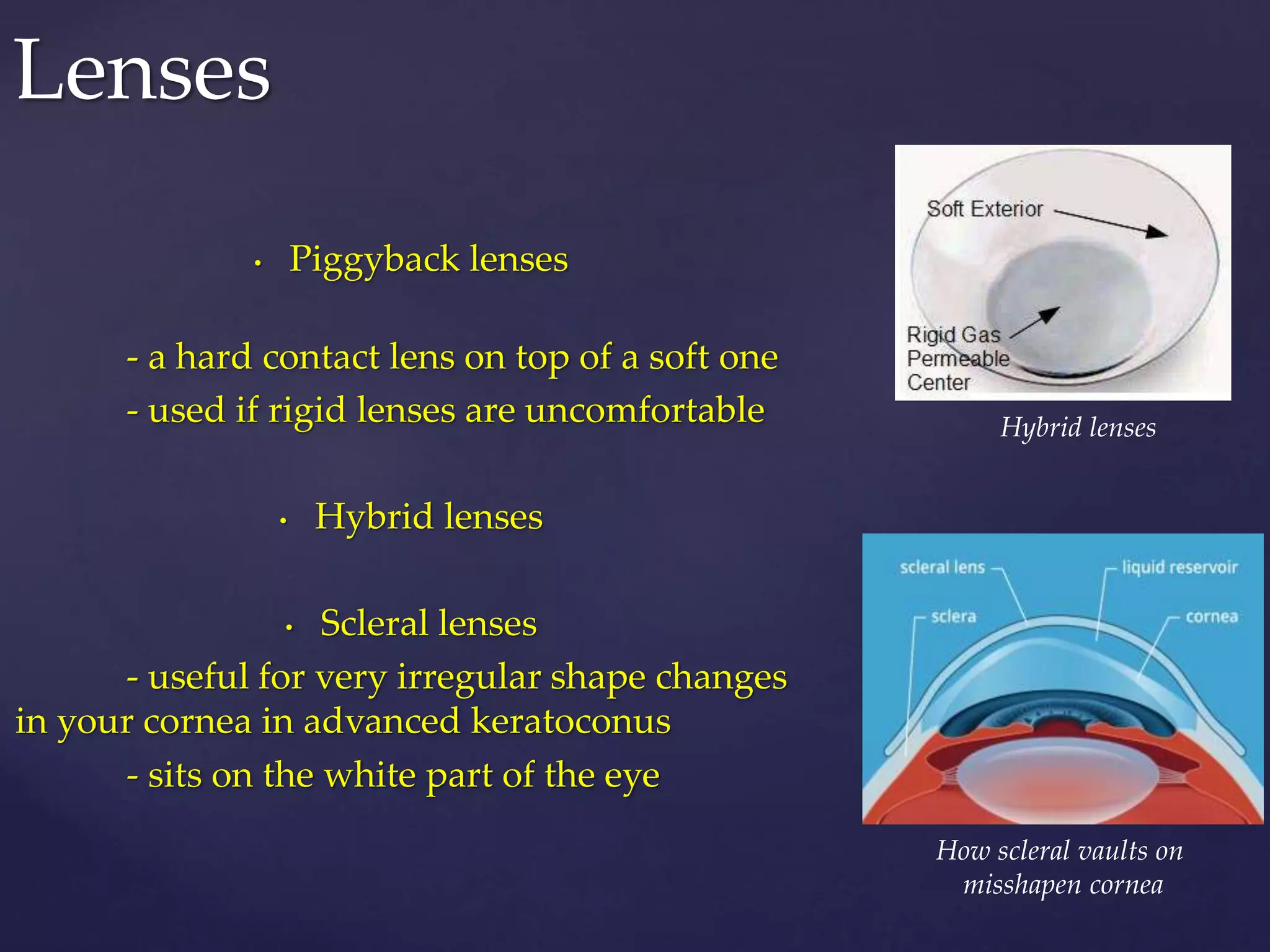 Keratoconus presentation | PPTX