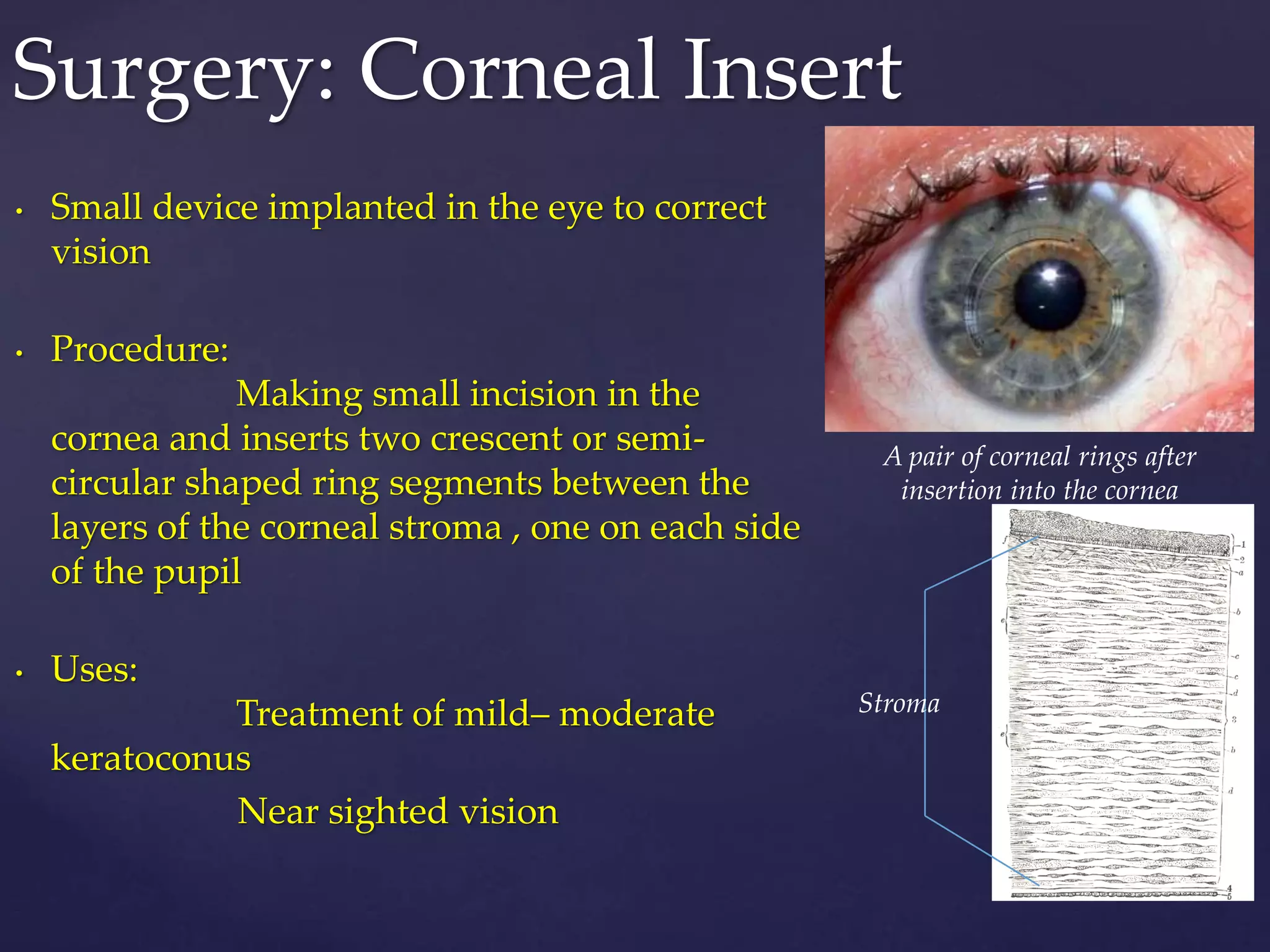 Keratoconus presentation | PPTX